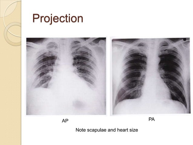 Chest radiography introduction | PPTX | Lung and Respiratory Health ...