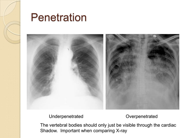 Chest radiography introduction | PPTX | Lung and Respiratory Health ...