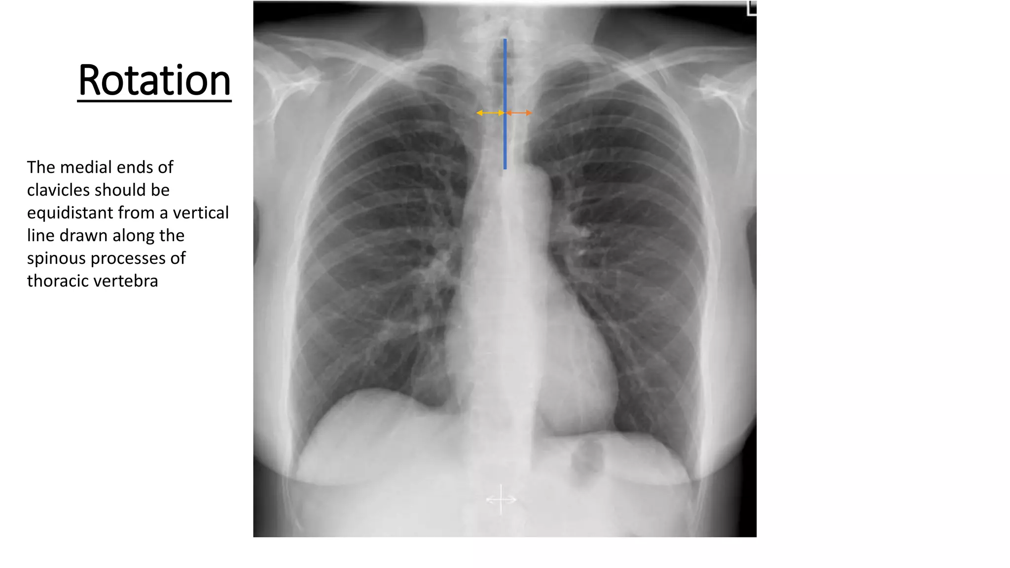 Chest radiography positioning and Technique.pptx