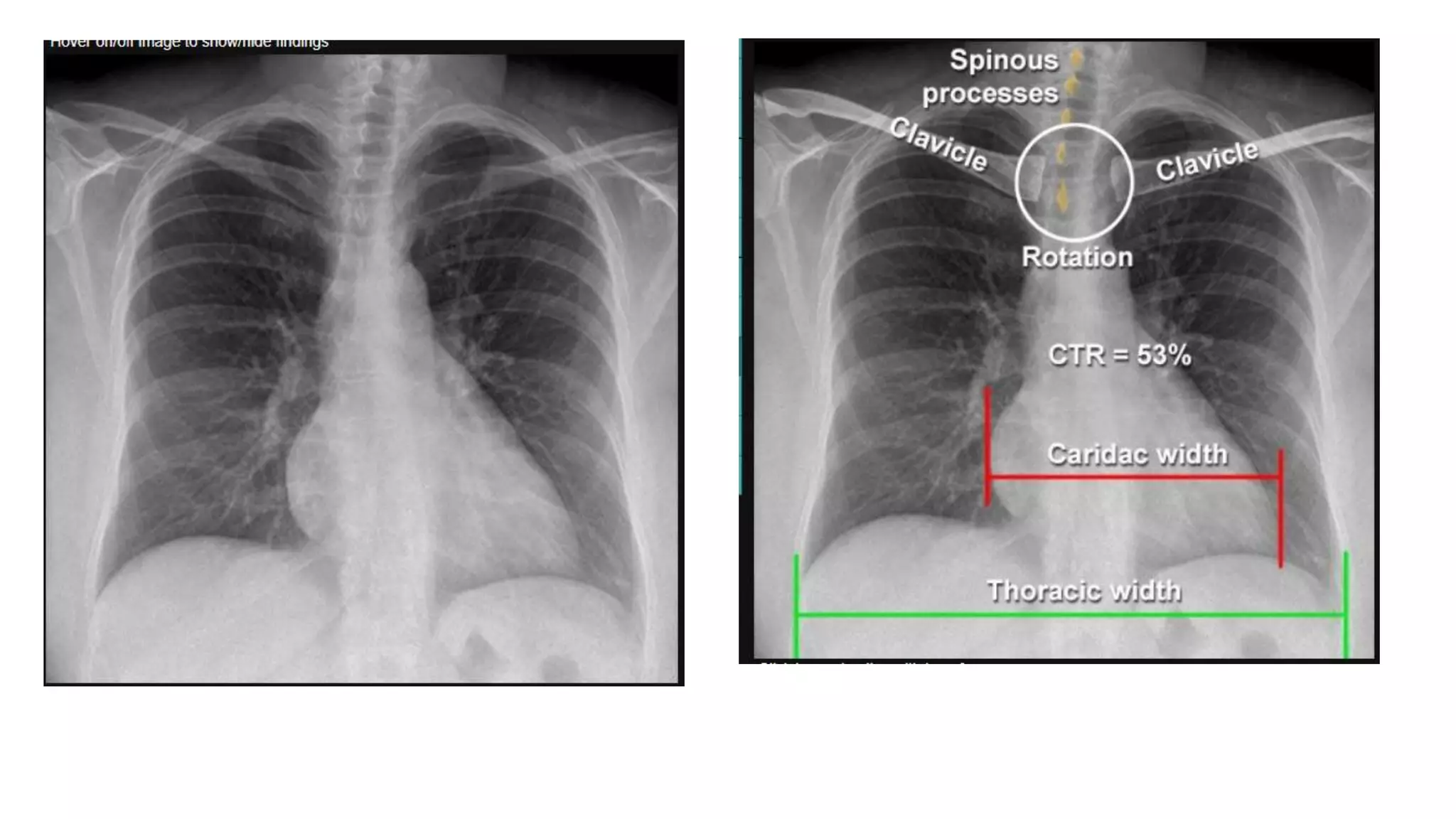 Chest radiography positioning and Technique.pptx