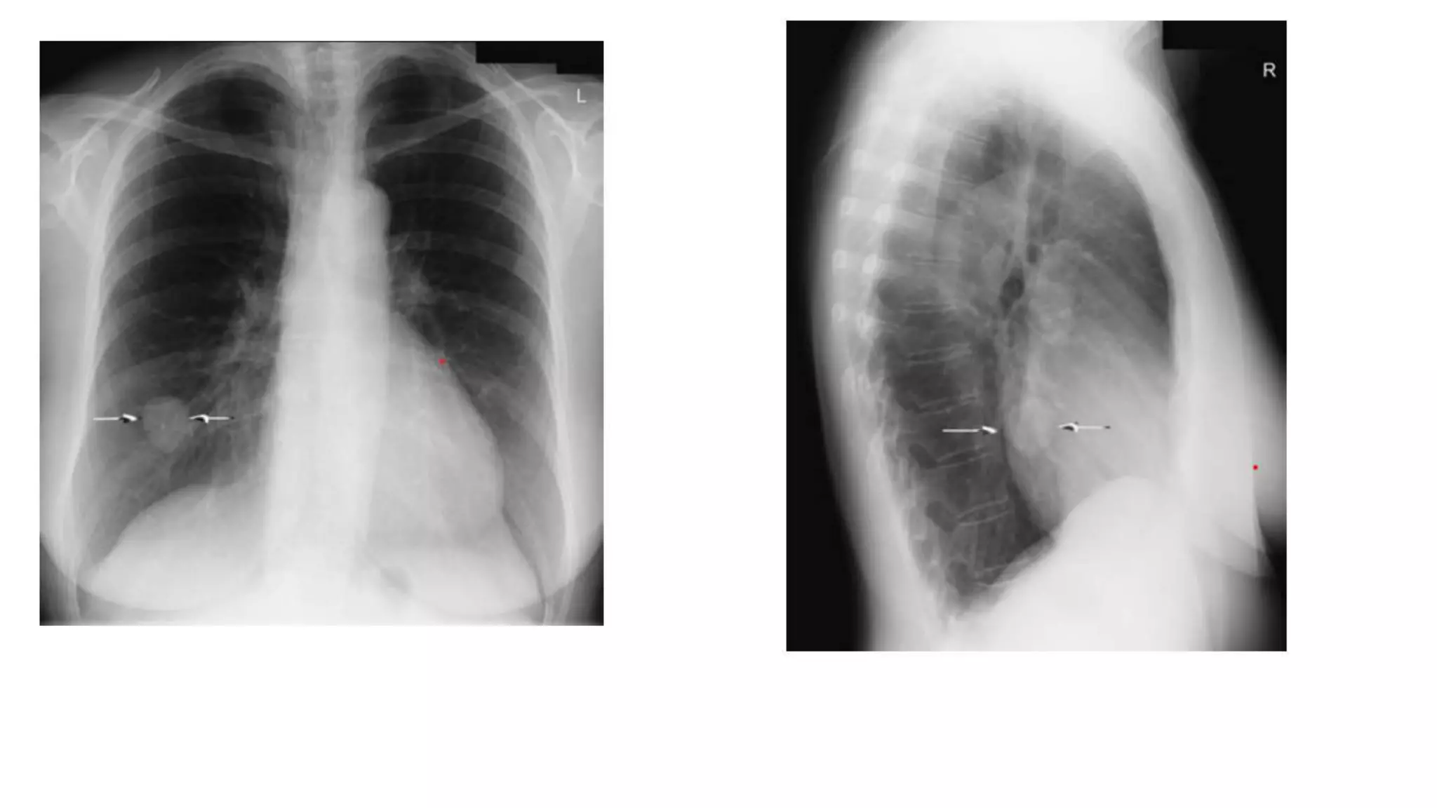 Chest radiography positioning and Technique.pptx