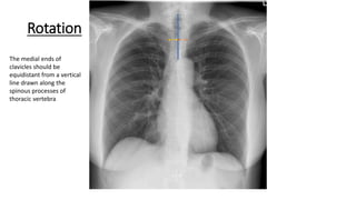 Chest radiography positioning and Technique.pptx