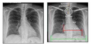 Chest radiography positioning and Technique.pptx