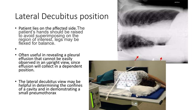 Chest radiography positioning and Technique.pptx | Death, Injury, or ...