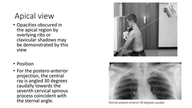 Chest radiography positioning and Technique.pptx | Death, Injury, or ...