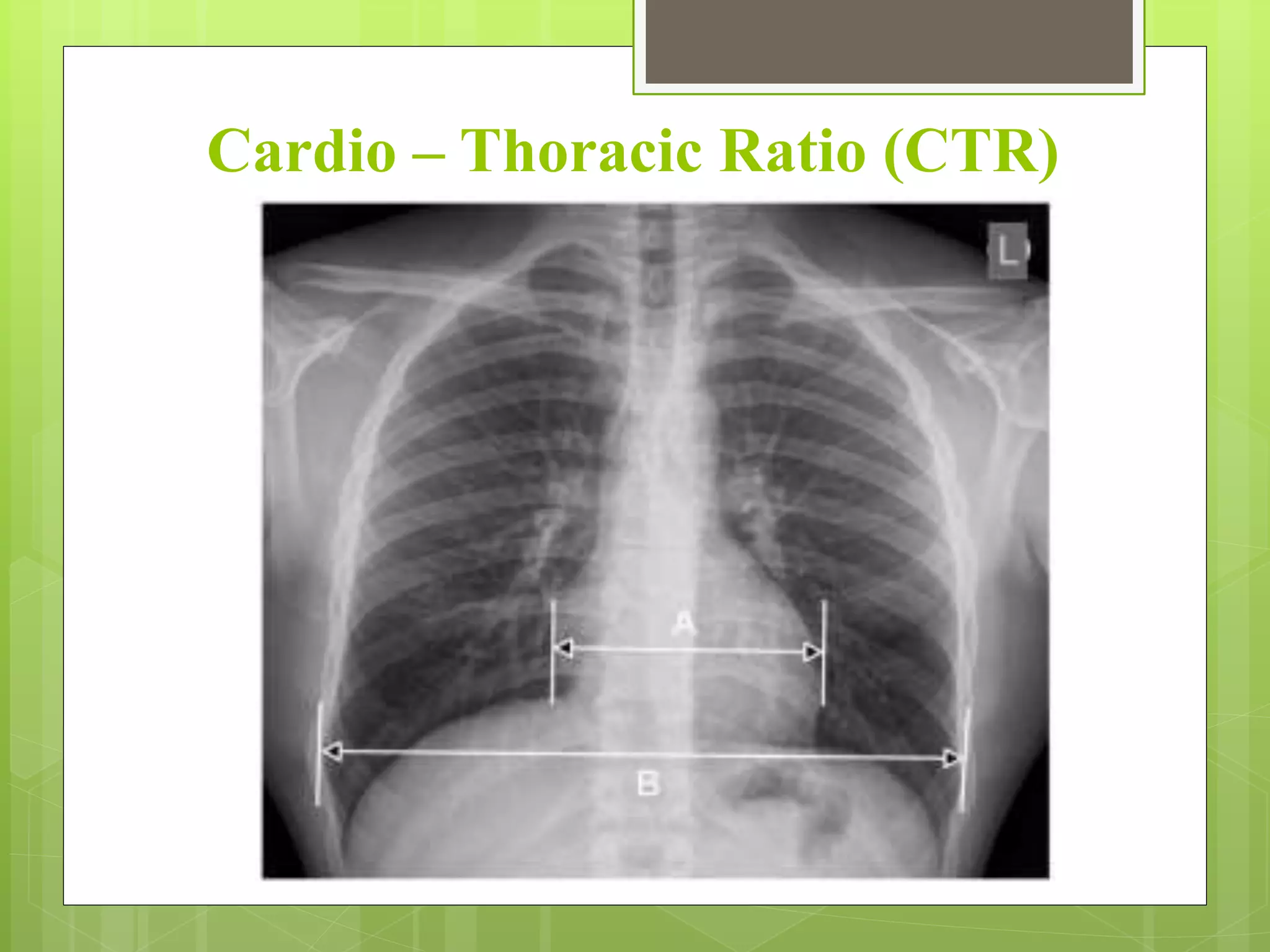 CHEST RADIOGRAPHY - Routine & special radiographs | PPTX