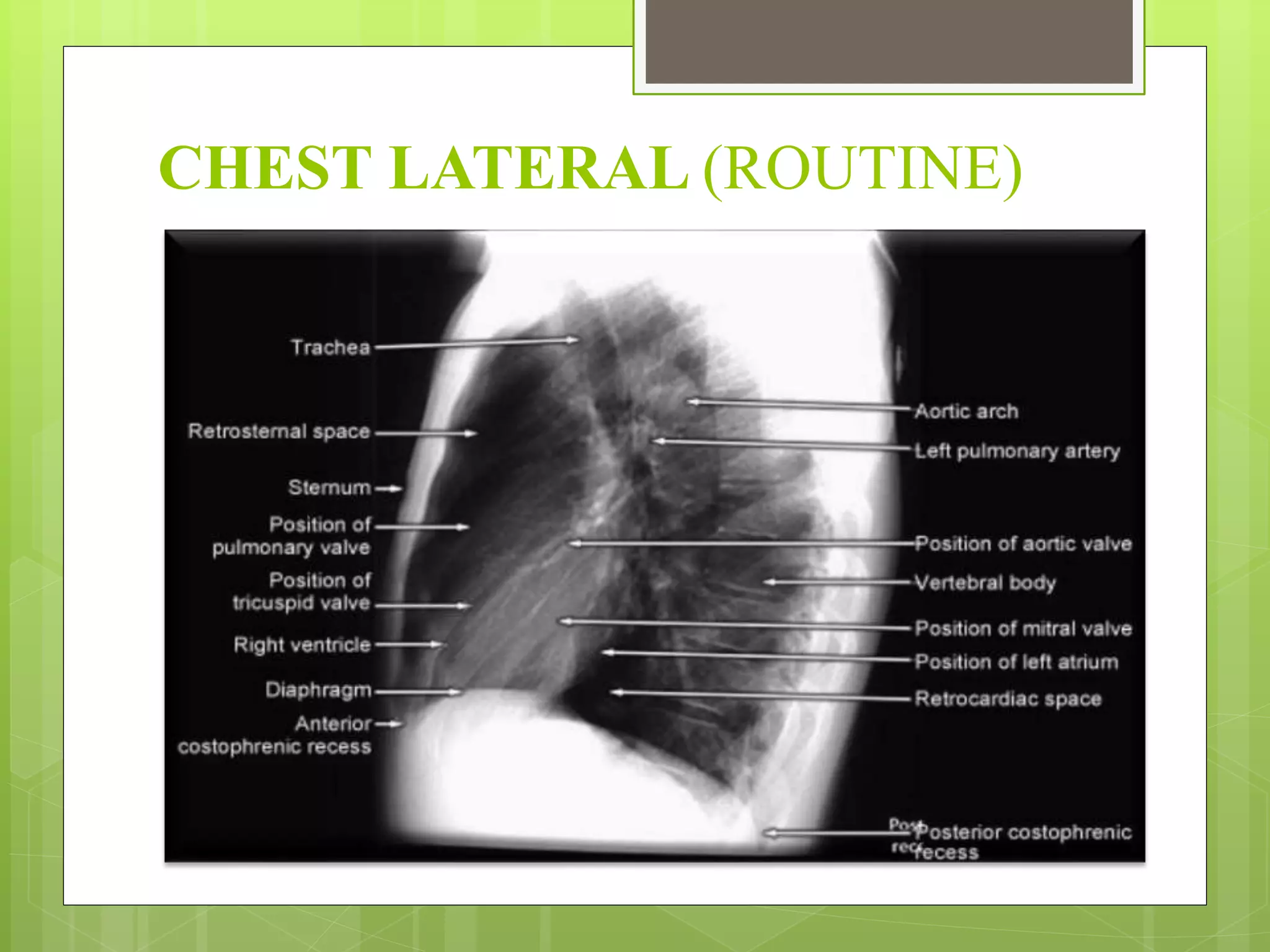 CHEST RADIOGRAPHY - Routine & special radiographs | PPTX
