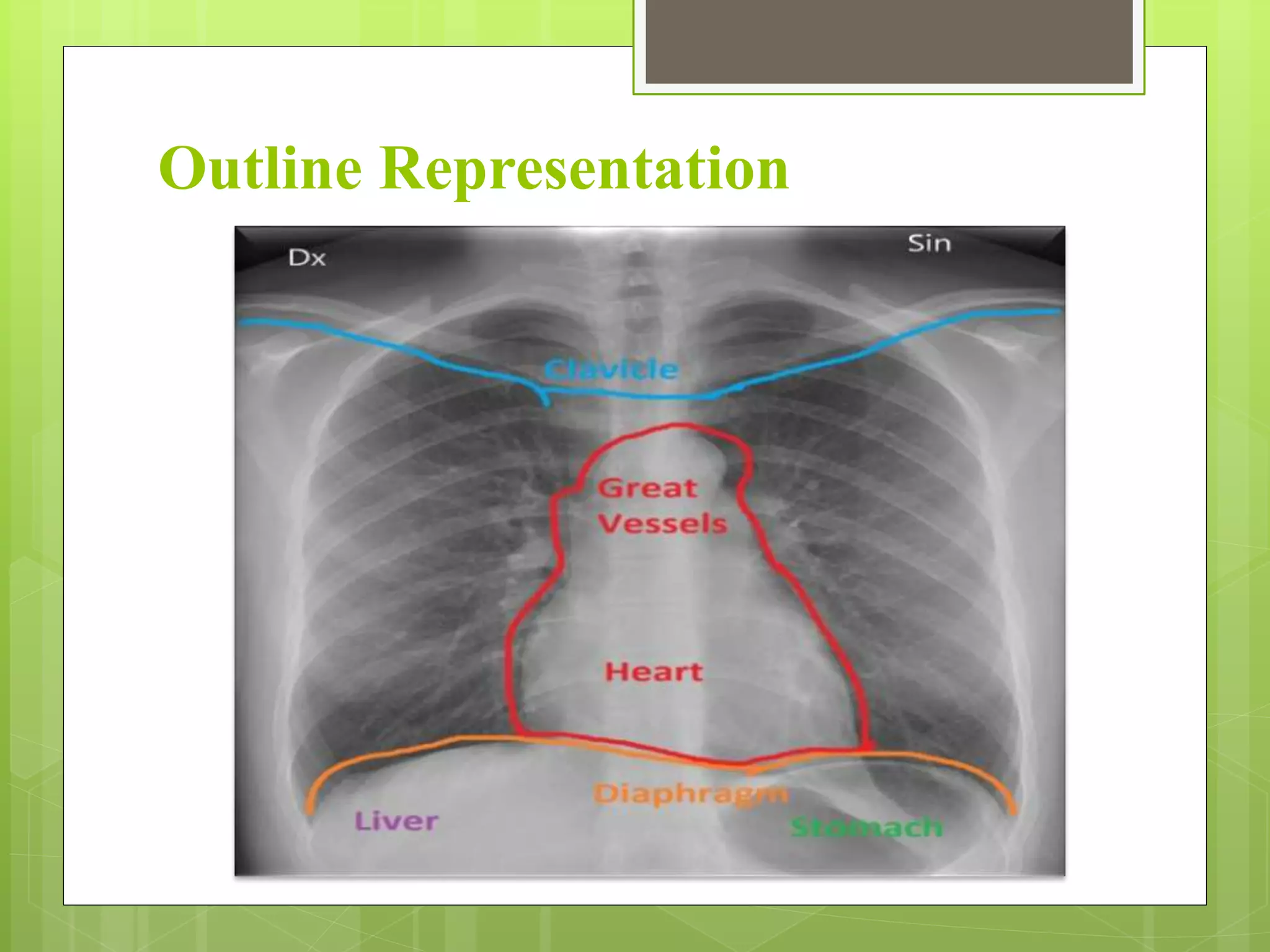 CHEST RADIOGRAPHY - Routine & special radiographs | PPTX