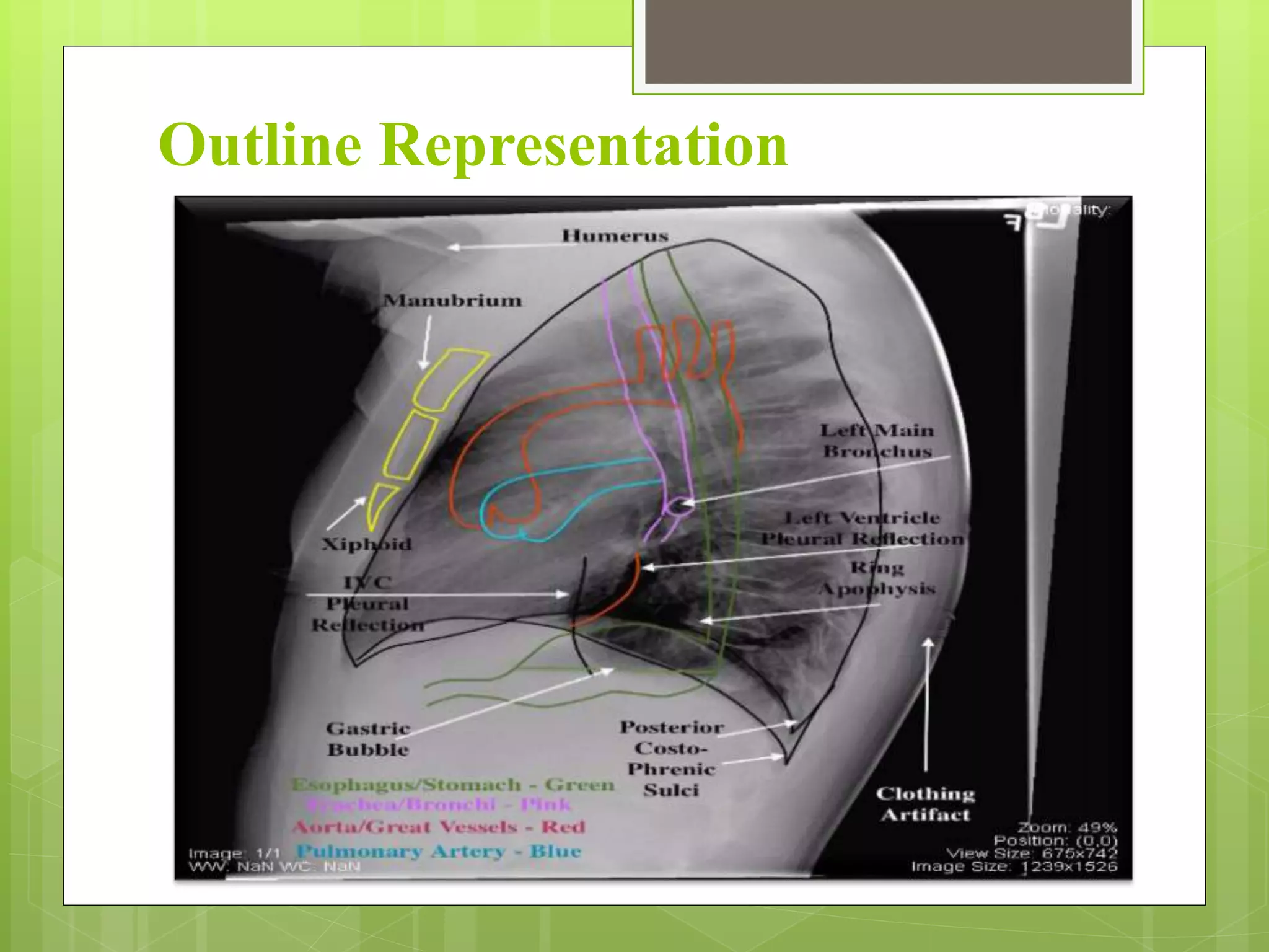 CHEST RADIOGRAPHY - Routine & special radiographs | PPTX