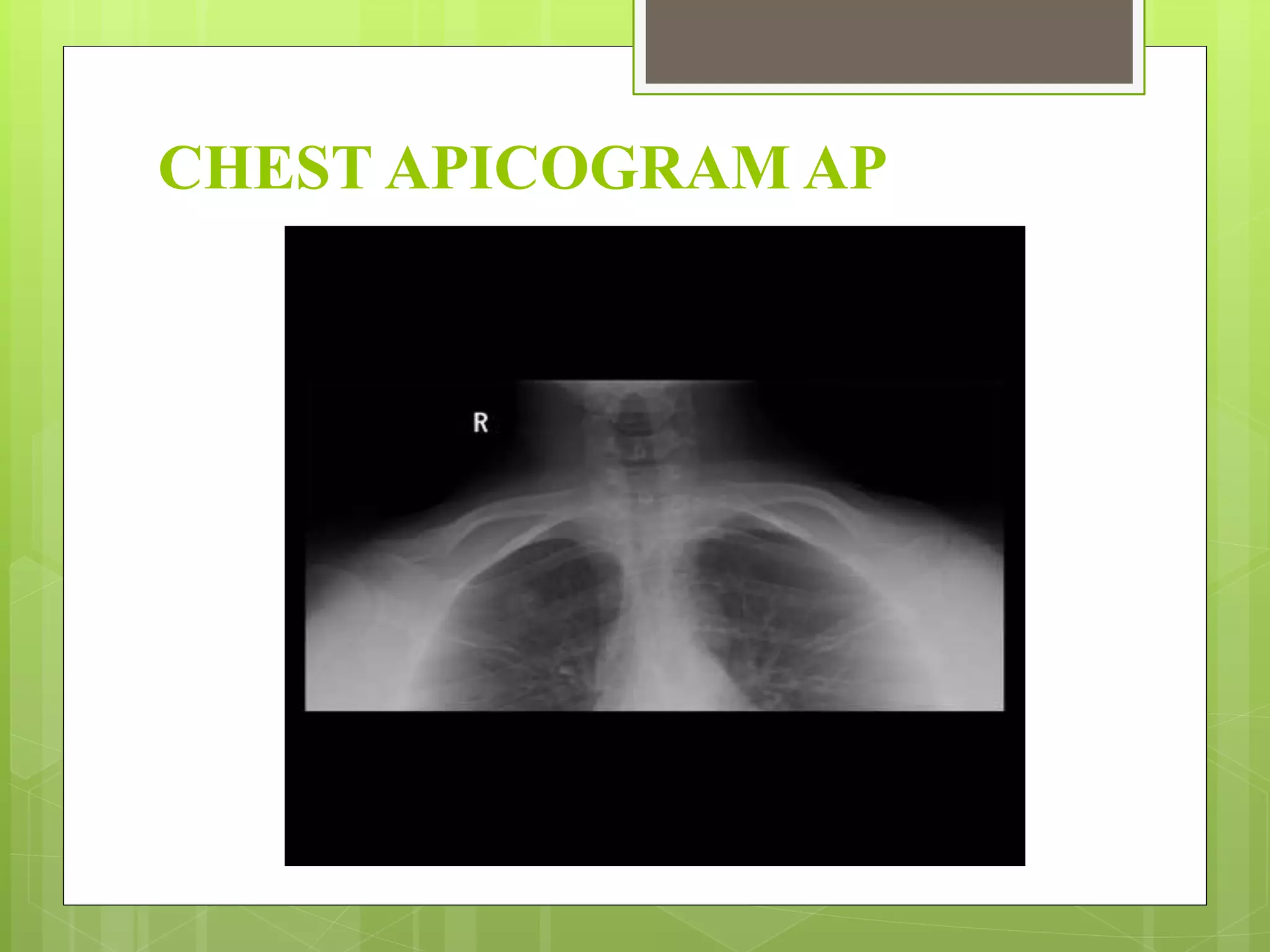 CHEST RADIOGRAPHY - Routine & special radiographs | PPTX