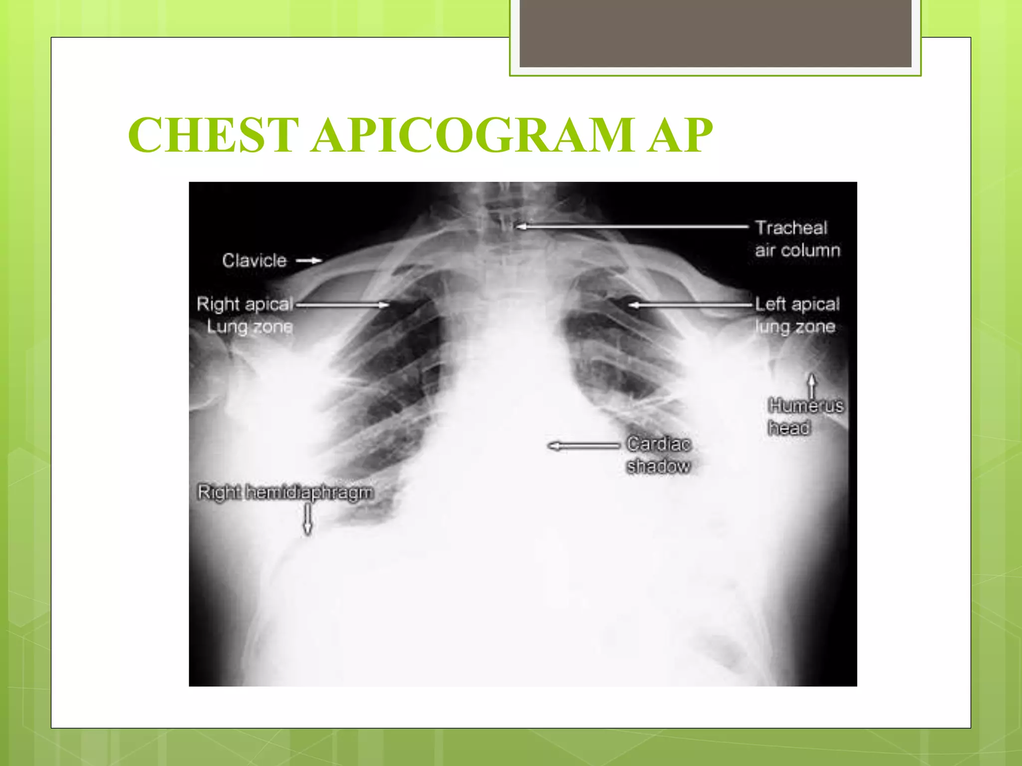 CHEST RADIOGRAPHY - Routine & special radiographs | PPTX