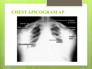 CHEST RADIOGRAPHY - Routine & special radiographs | PPT