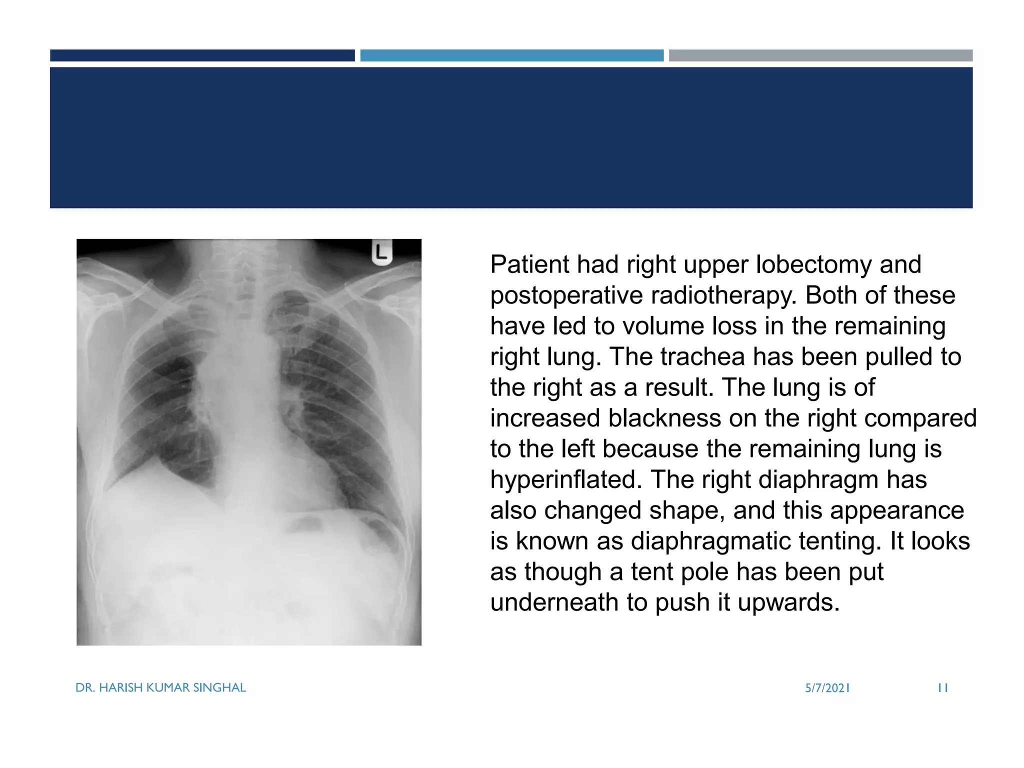 Basics of Chest X Ray Reading | PDF