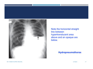 Basics of Chest X Ray Reading | PDF