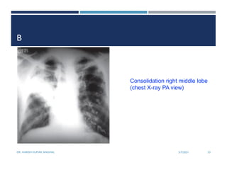 Basics of Chest X Ray Reading | PDF