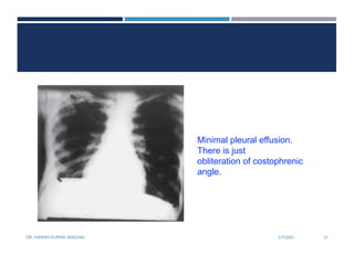 Costodiaphragmatic Angle