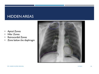 Basics of Chest X Ray Reading | PPT