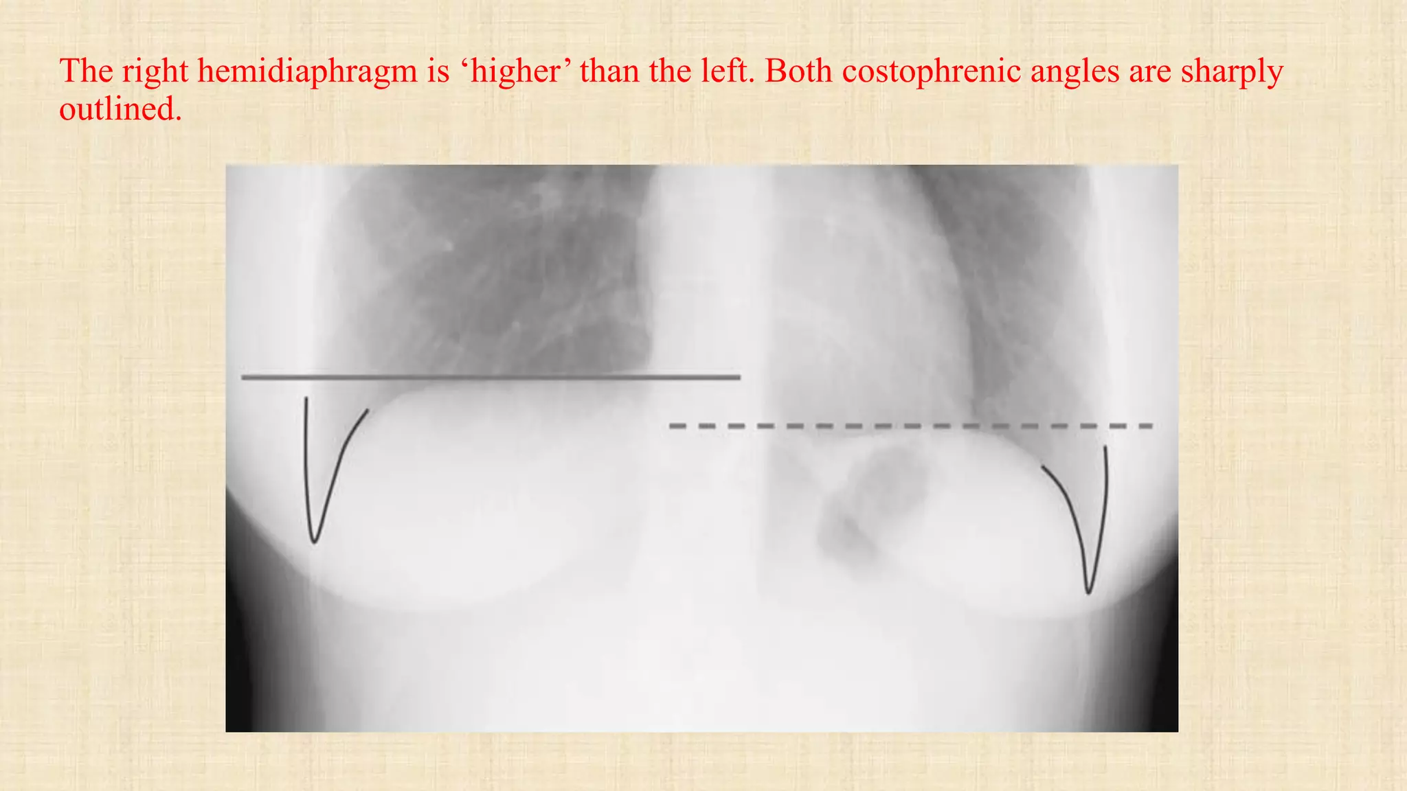 Chest radiology | PPT