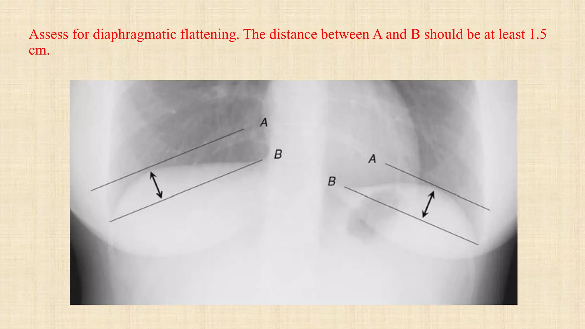 Chest radiology | PPT