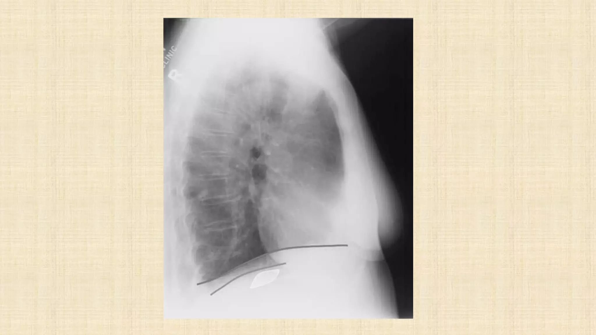 Chest radiology | PPT