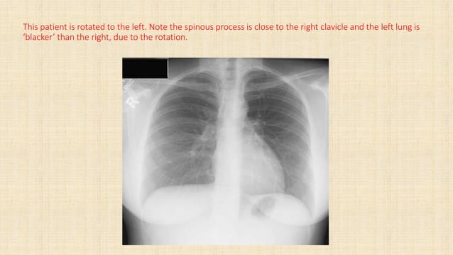 Chest radiology | PPT