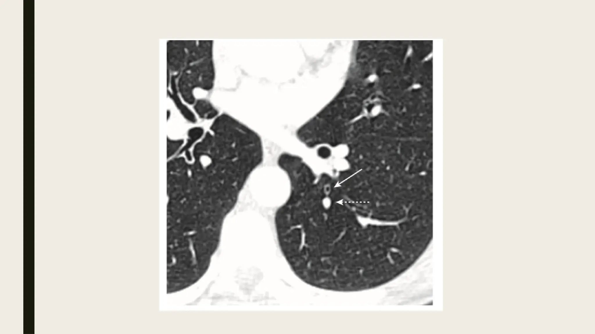 CHEST RADIOLOGY (Respiratory System).pptx