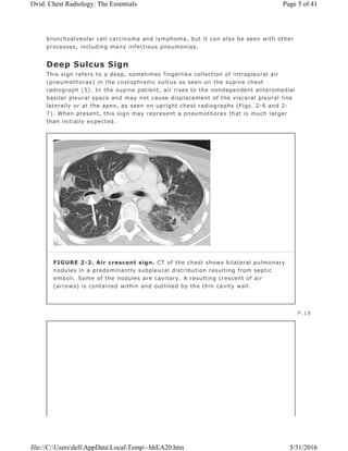 Chest radiology essentials signs | PDF