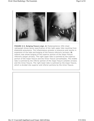 Chest radiology essentials signs | PDF