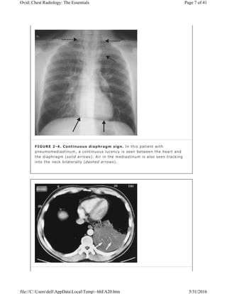 Chest radiology essentials signs | PDF