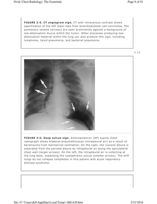 Chest radiology essentials signs | PDF