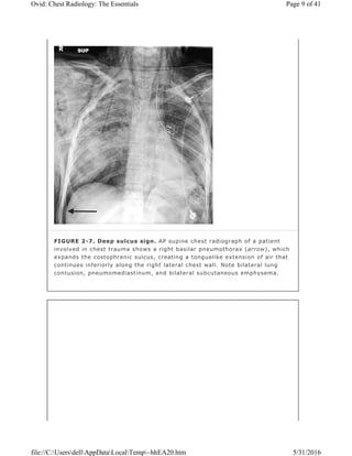 Chest radiology essentials signs | PDF