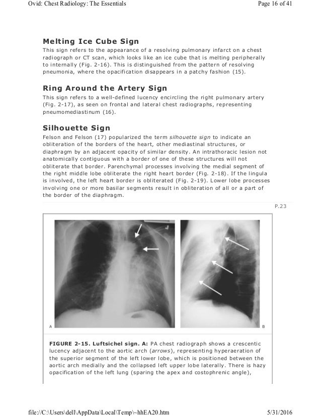 Chest radiology essentials signs