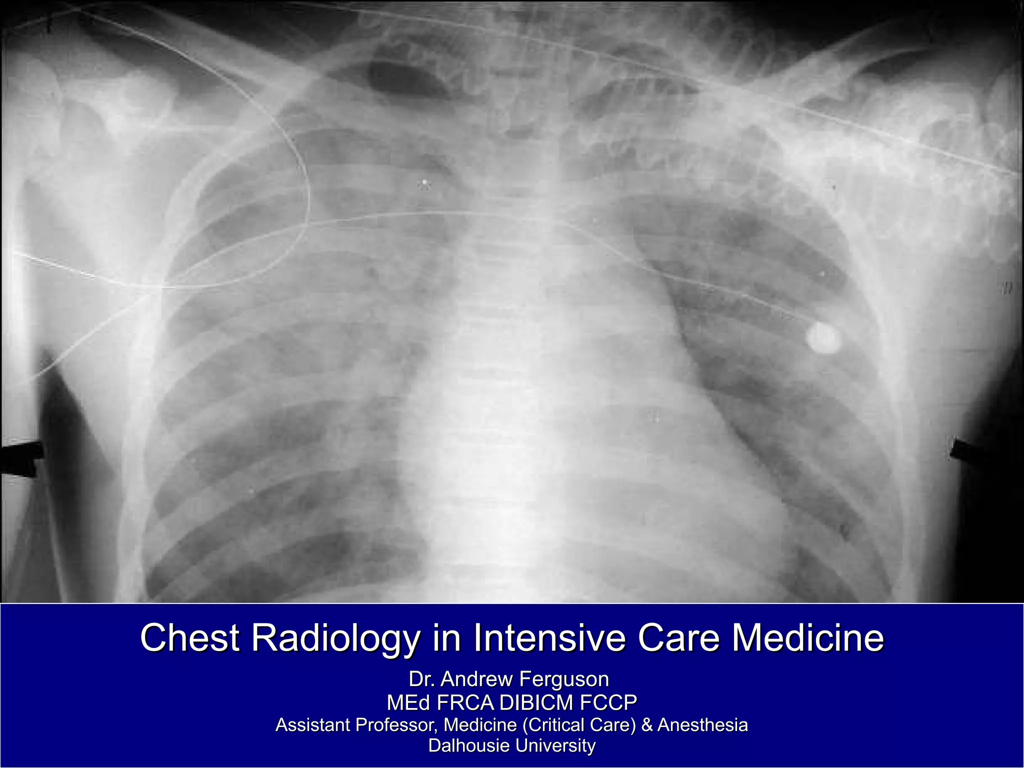 Chest radiology in intensive care | PPT