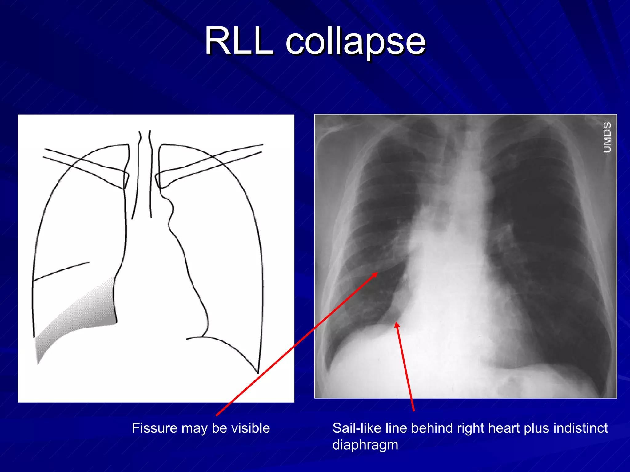 Chest radiology in intensive care | PPT