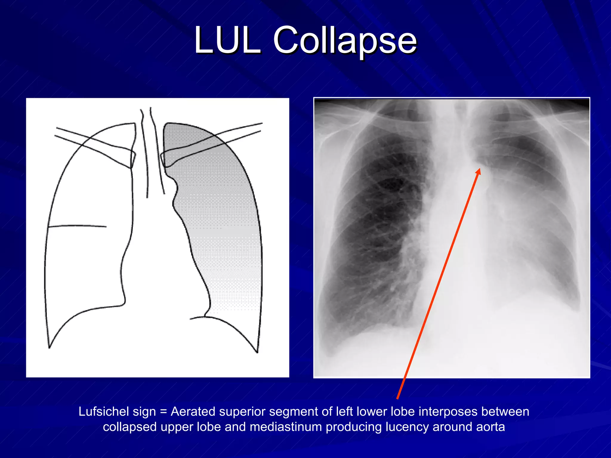 Chest radiology in intensive care | PPT