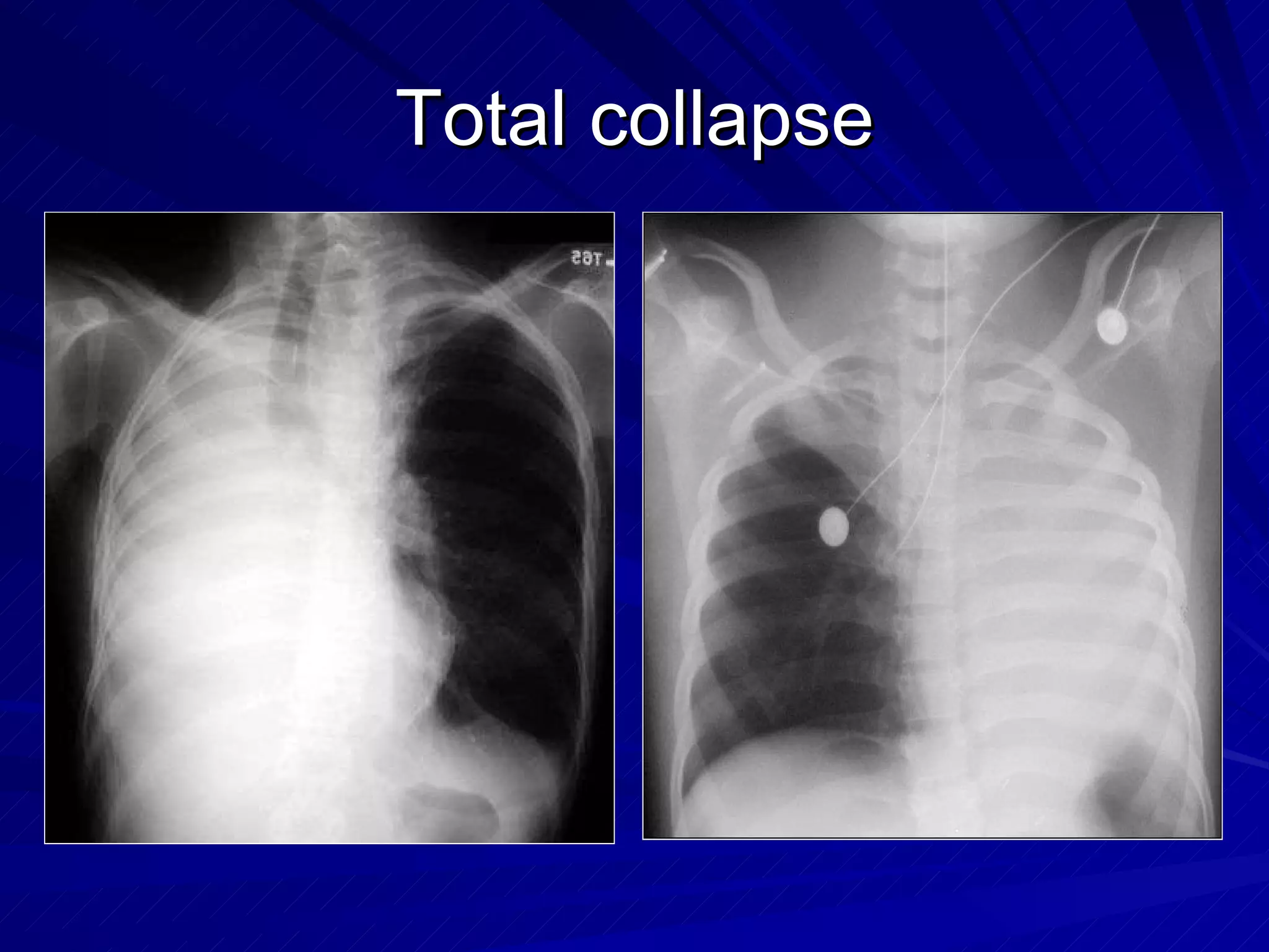 Chest radiology in intensive care | PPT