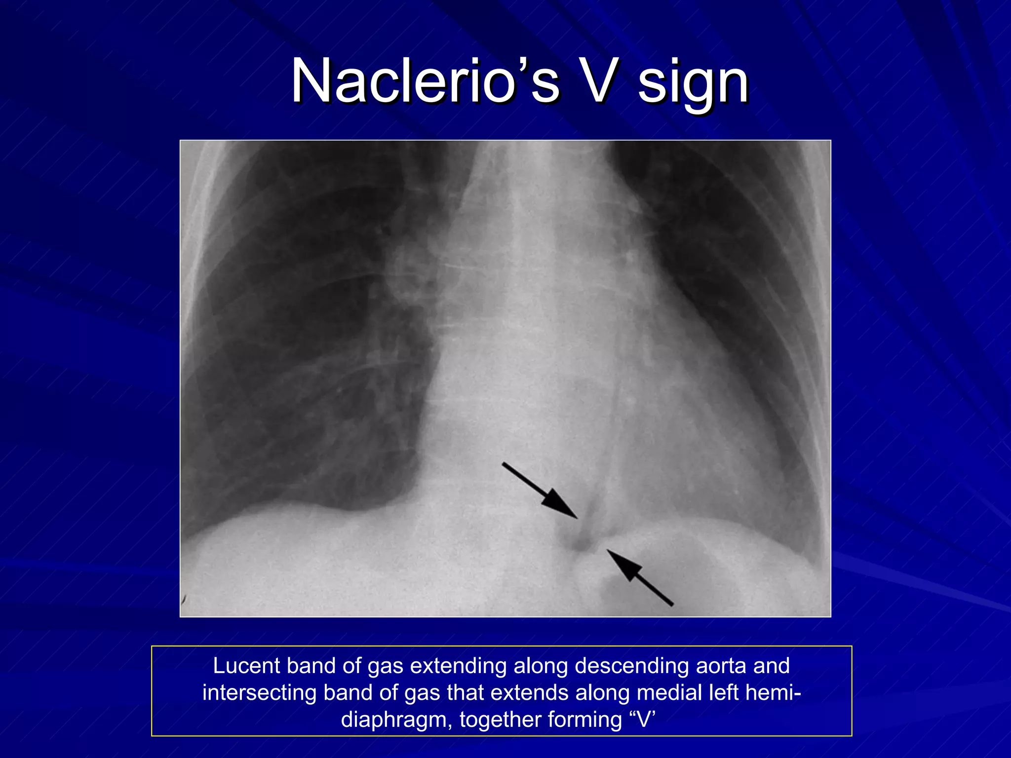 Chest radiology in intensive care | PPT