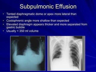 Chest radiology in intensive care | PPT
