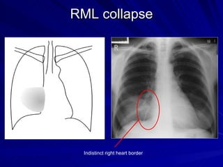 Chest radiology in intensive care | PPT
