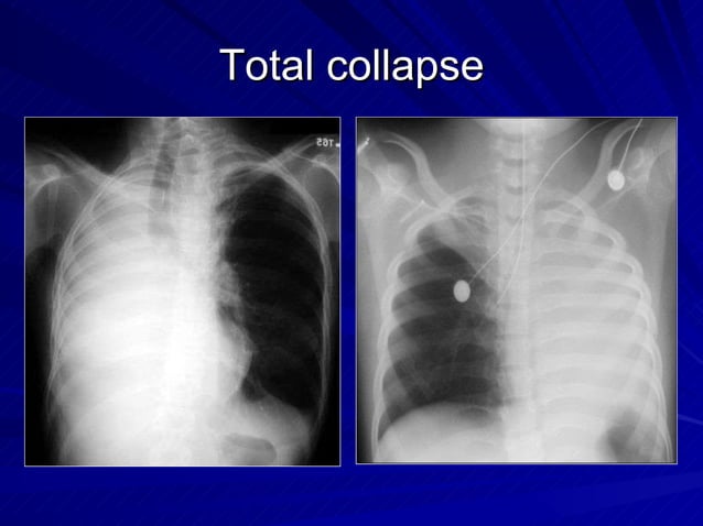 Chest radiology in intensive care | PPT