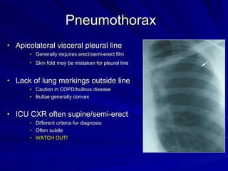 Chest radiology in intensive care | PPT
