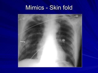 Chest radiology in intensive care | PPT