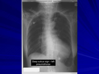 Chest radiology in intensive care | PPT