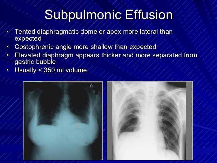 Chest radiology in intensive care