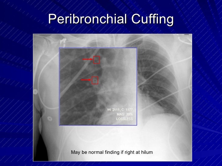 Chest radiology in intensive care