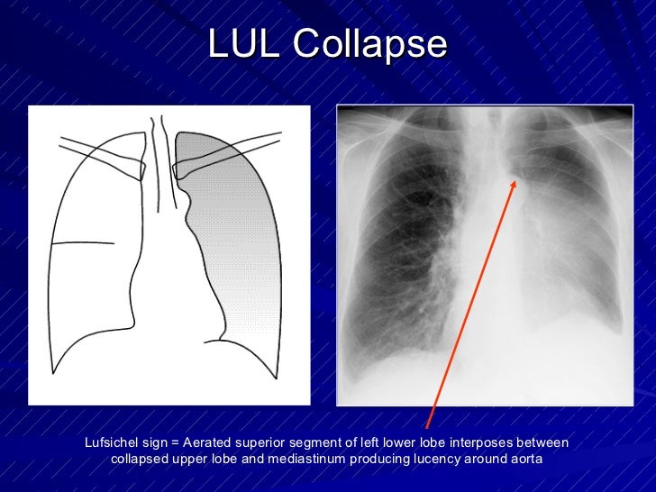 Chest radiology in intensive care