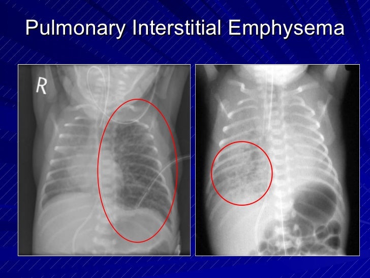 Chest radiology in intensive care