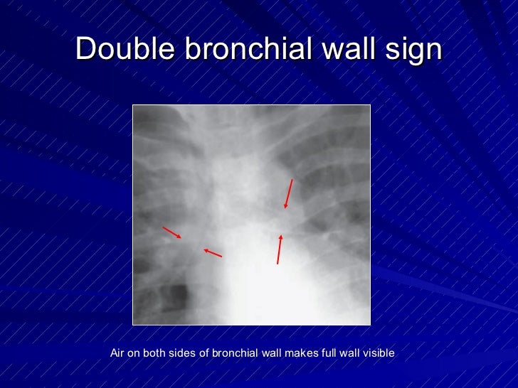 Chest radiology in intensive care