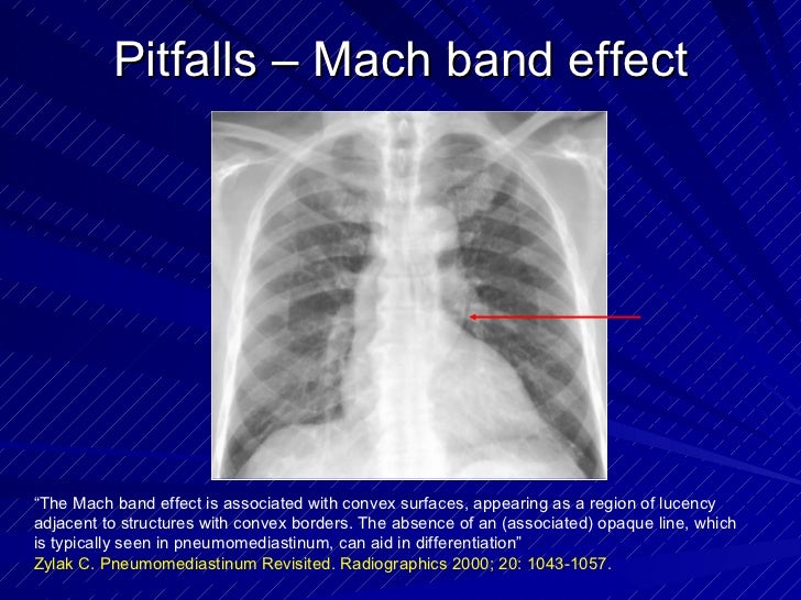 Chest radiology in intensive care