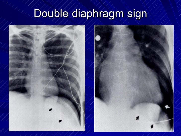 Chest radiology in intensive care
